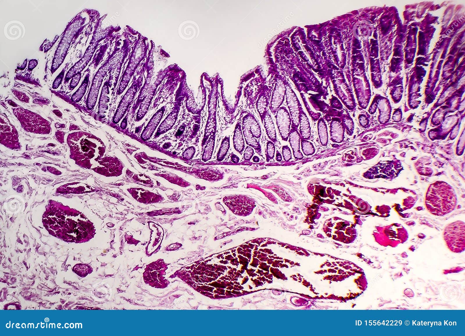 Villous Colon Adenocarcinoma, Light Micrograph Stock Image - Image of ...