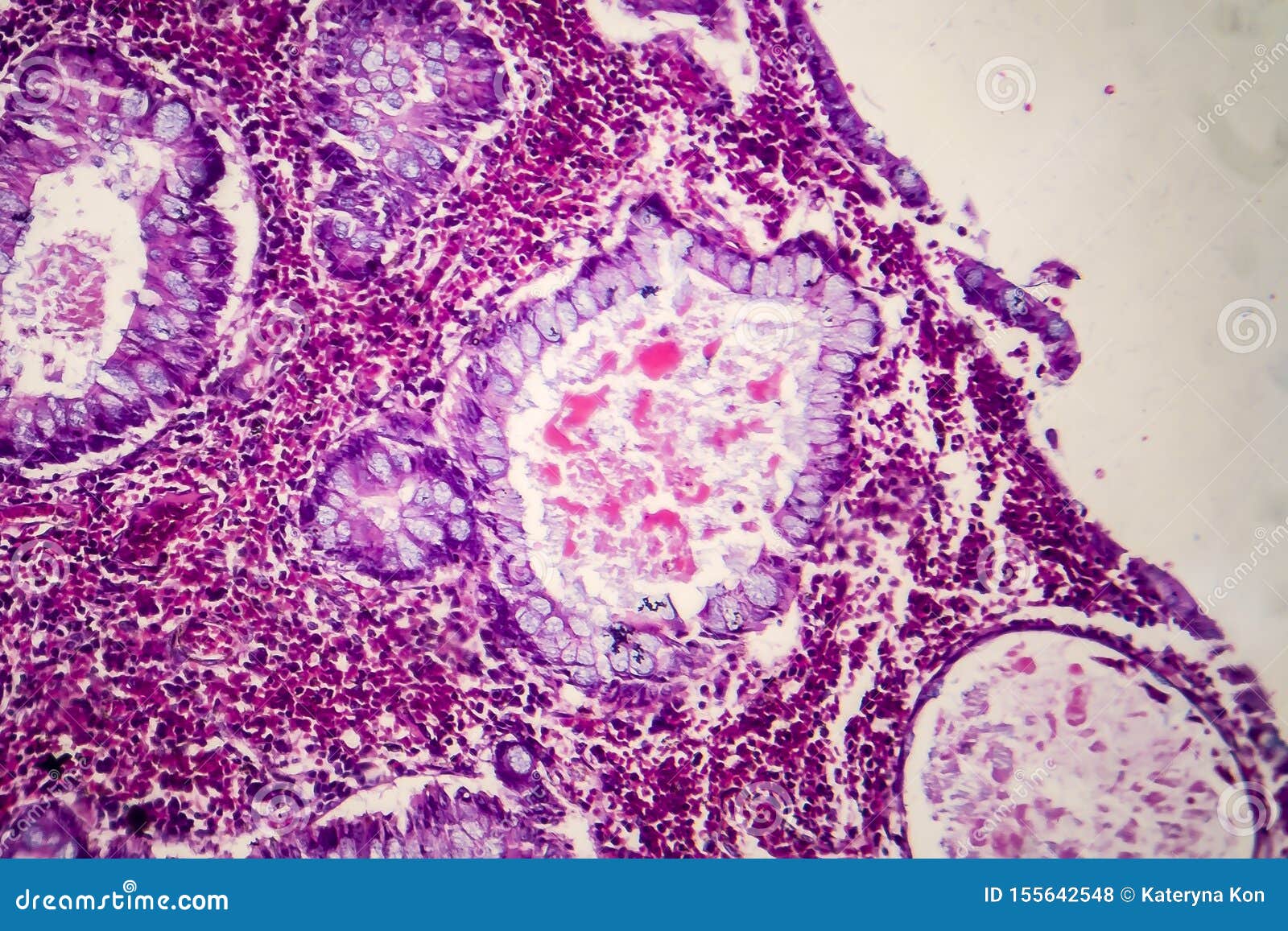 Villous Colon Adenocarcinoma, Light Micrograph Stock Photo ...
