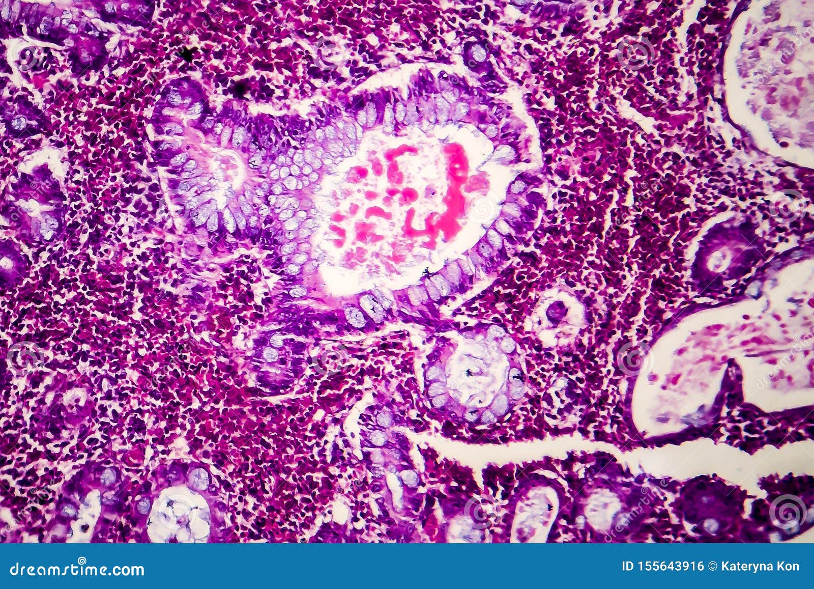 Villous Colon Adenocarcinoma, Light Micrograph Stock Image ...