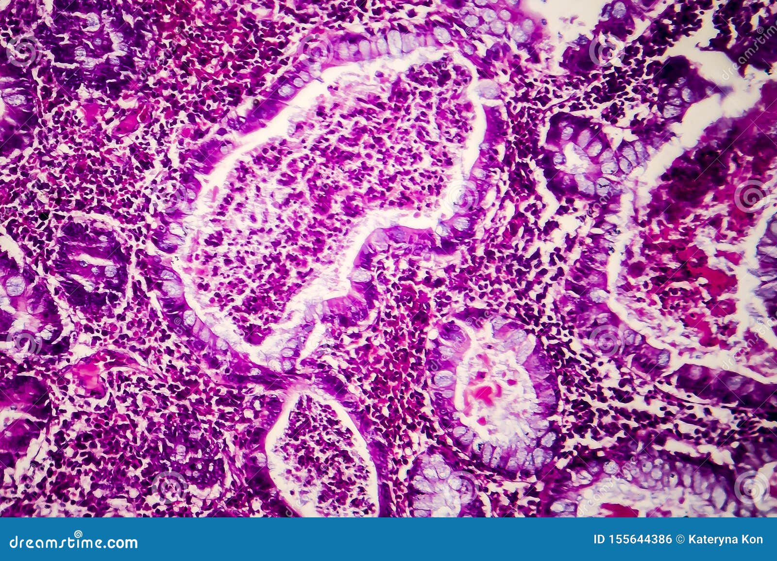 Villous Colon Adenocarcinoma, Light Micrograph Stock Photo - Image of ...