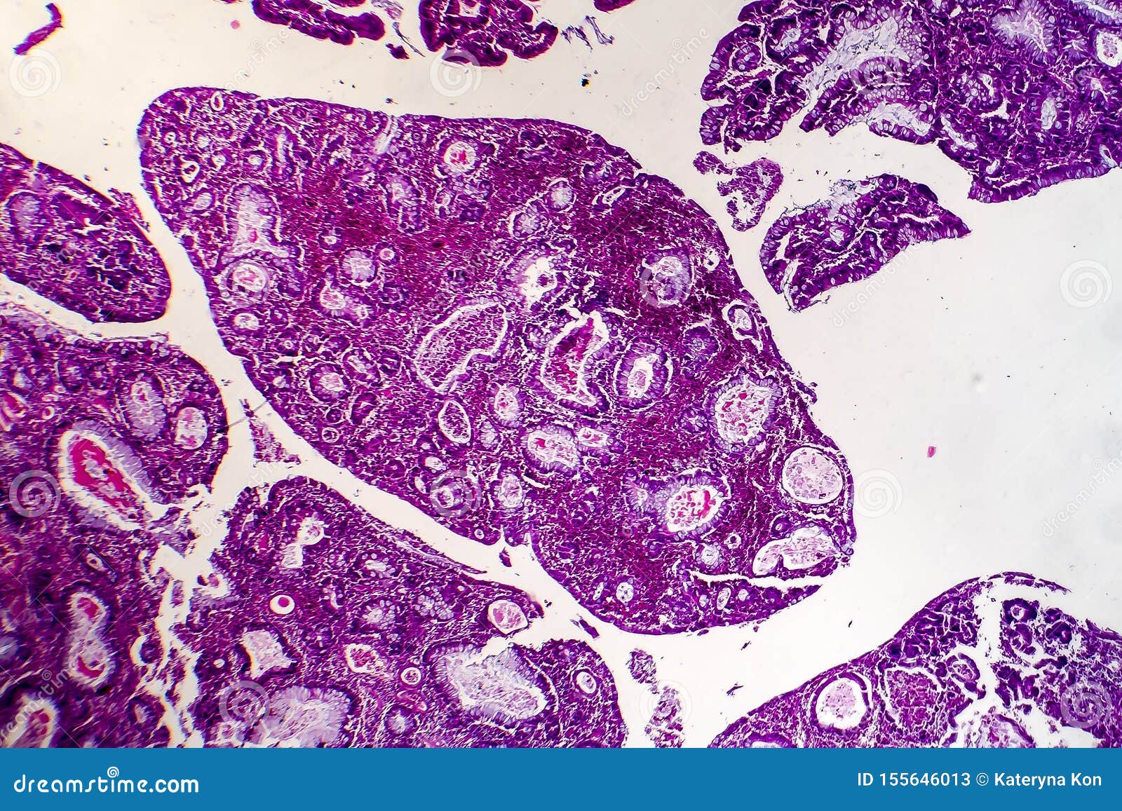 Villous Colon Adenocarcinoma, Light Micrograph Stock Image - Image of ...