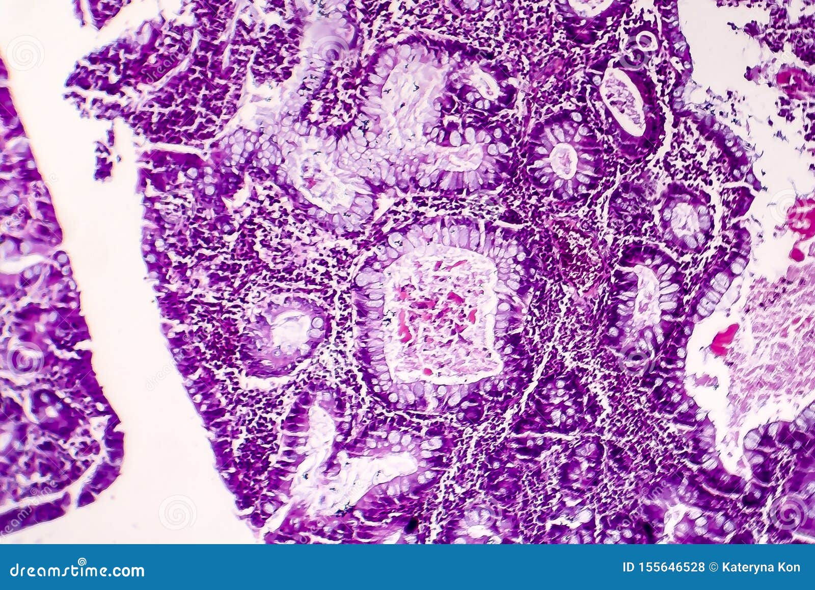 Villous Colon Adenocarcinoma, Light Micrograph Stock Photo - Image of ...