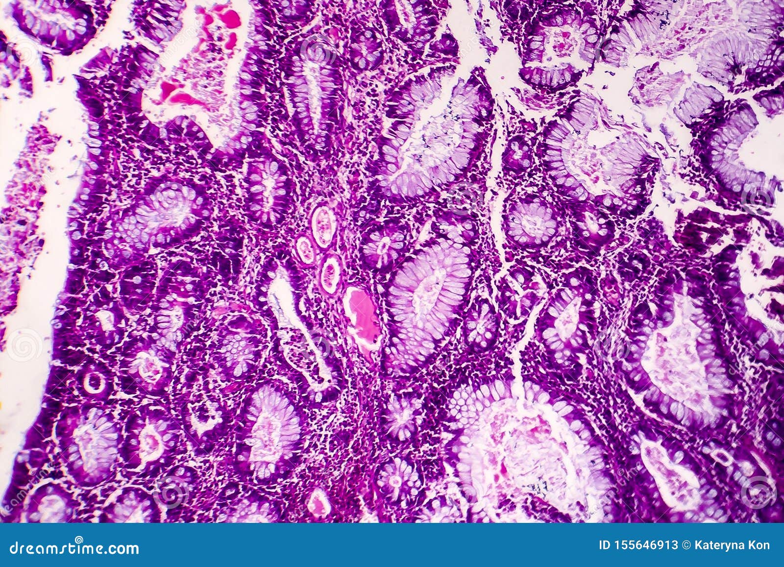 Villous Colon Adenocarcinoma, Light Micrograph Stock Image - Image of ...