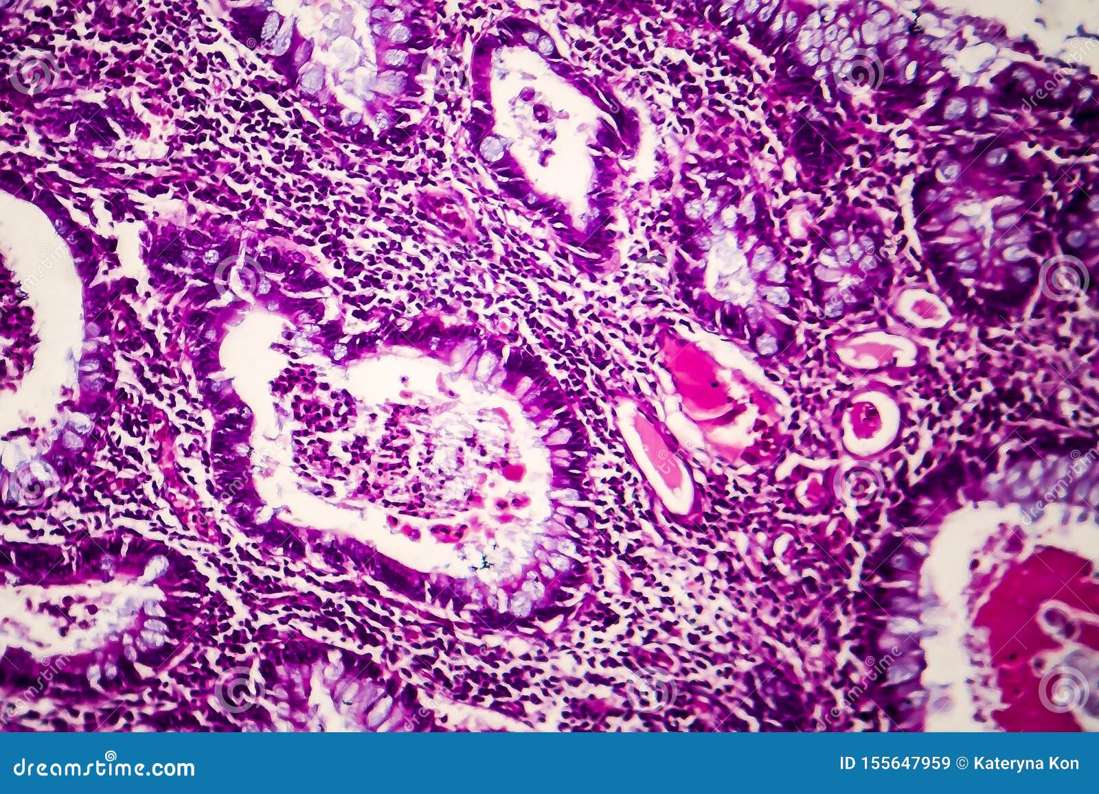 Villous Colon Adenocarcinoma, Light Micrograph Stock Image - Image of ...