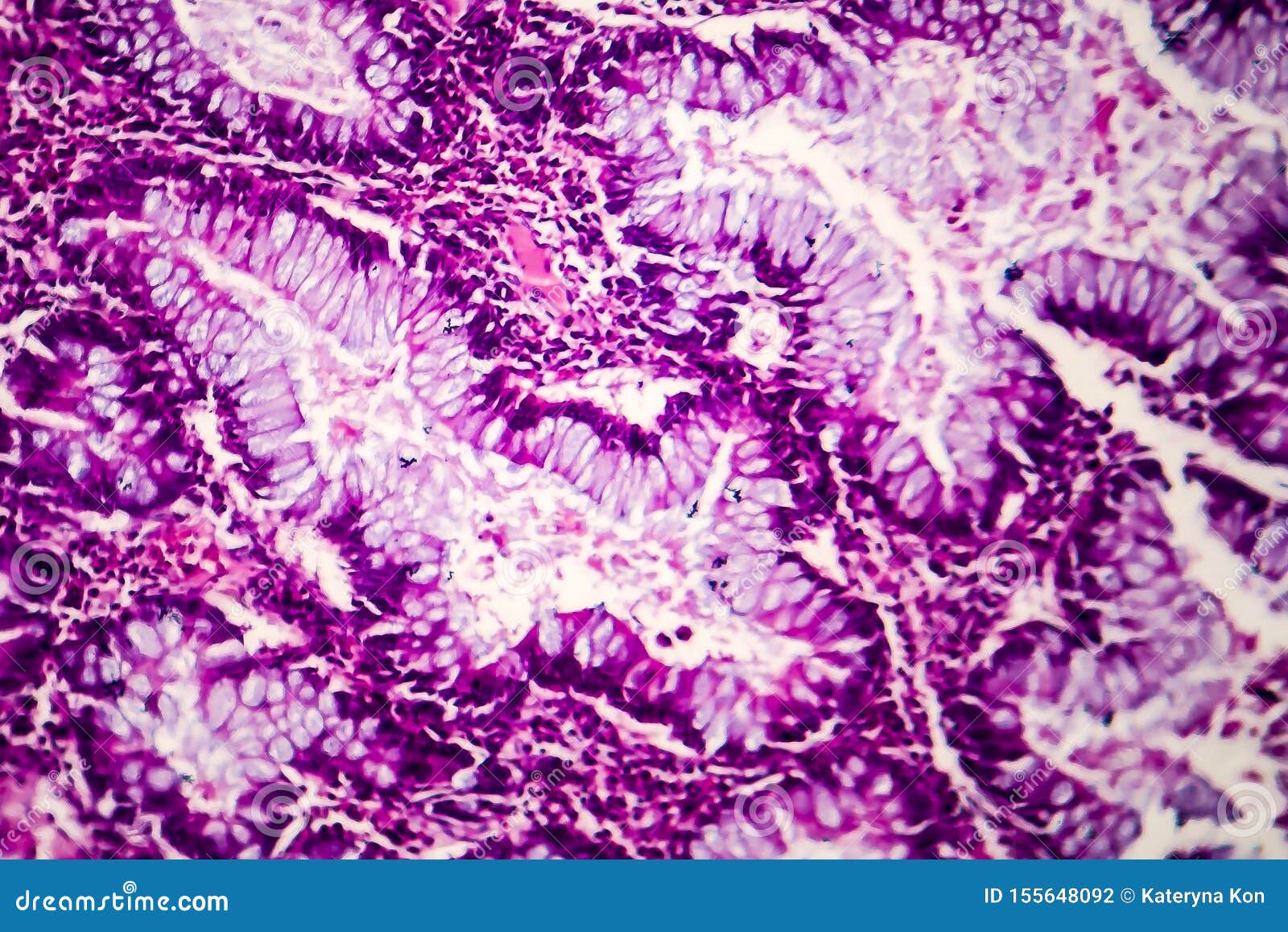 Villous Colon Adenocarcinoma, Light Micrograph Stock Photo - Image of ...