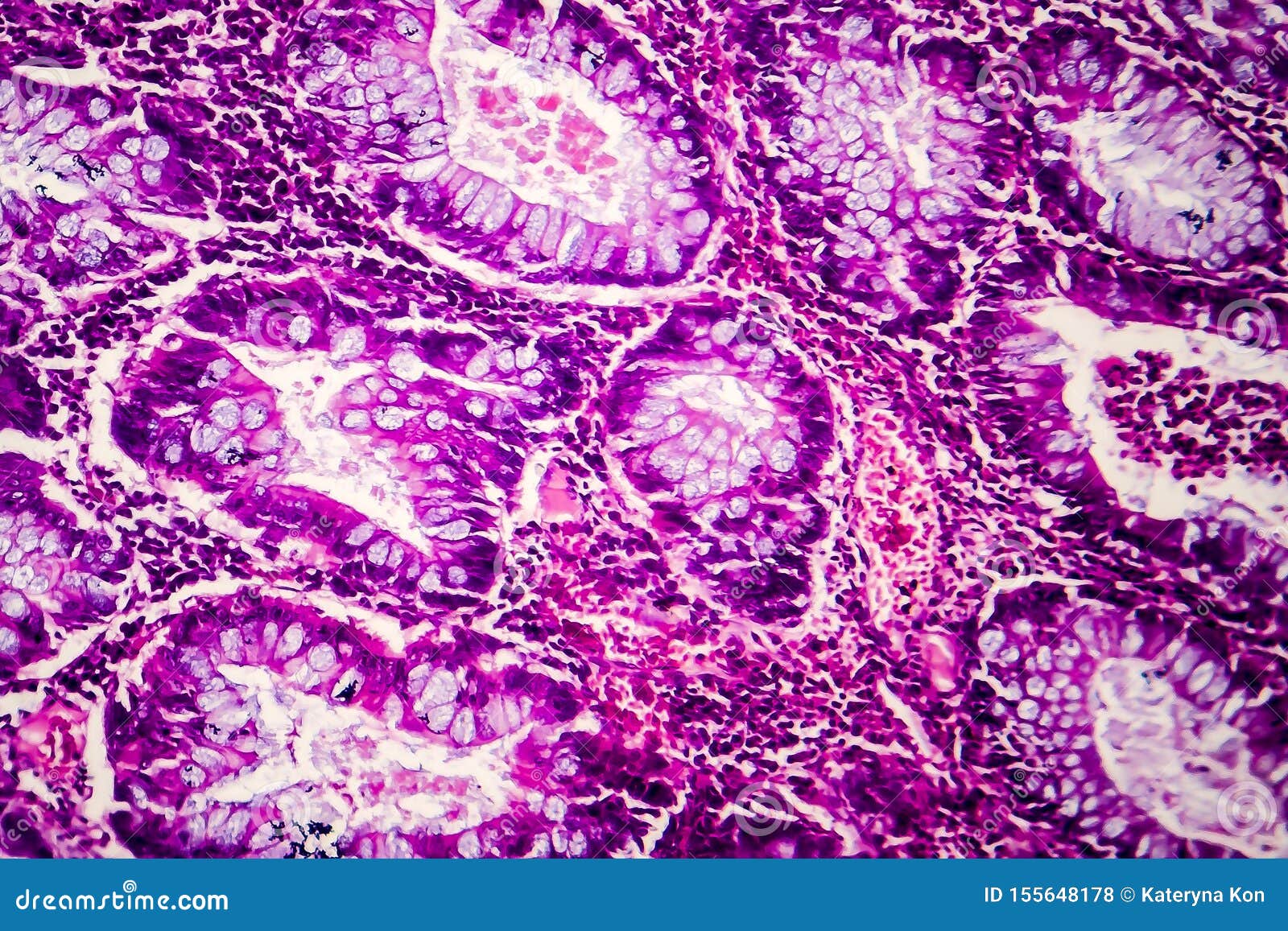 Villous Colon Adenocarcinoma, Light Micrograph Stock Photo - Image of ...
