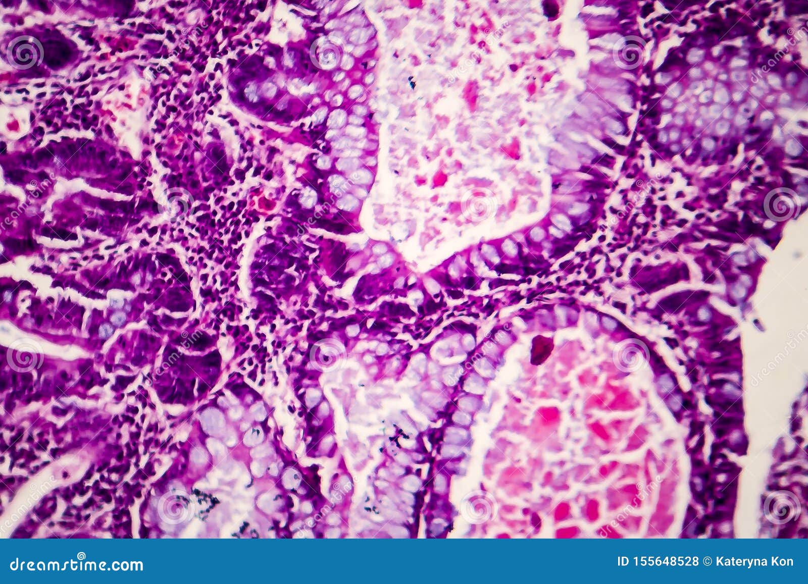 Colon Adenocarcinoma, Cancer Of Colon Royalty-Free Stock Photography ...