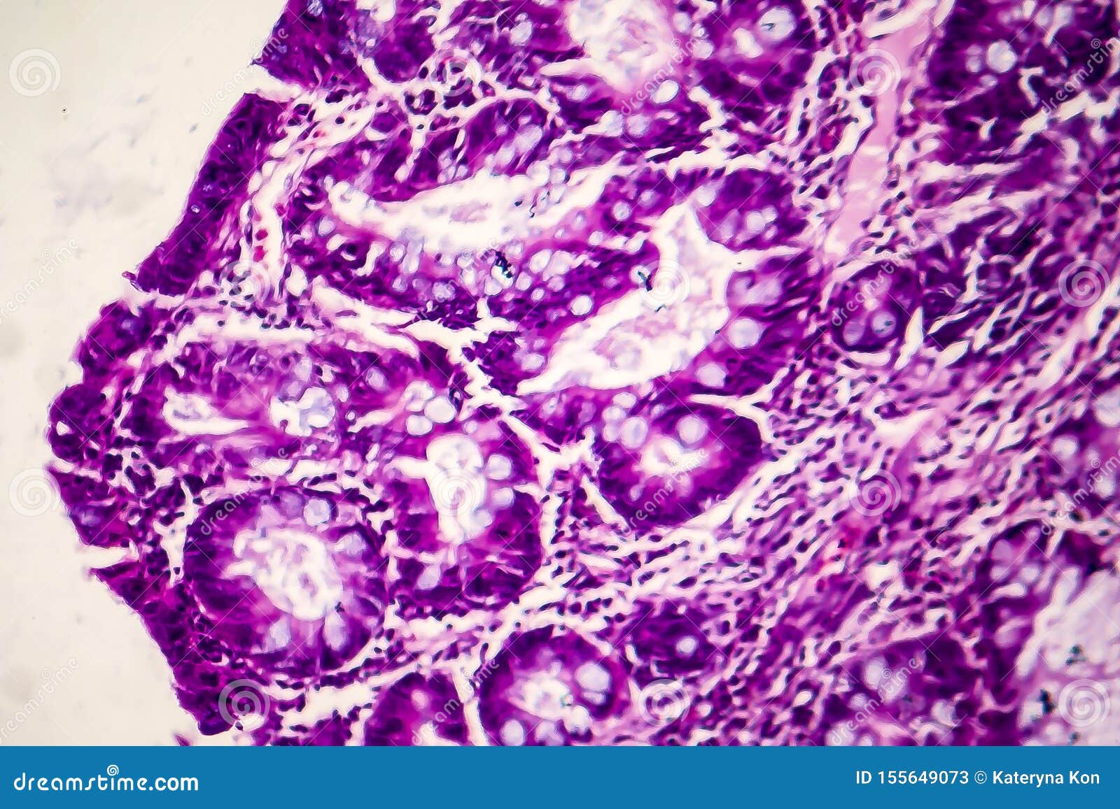 Villous Colon Adenocarcinoma, Light Micrograph Stock Image - Image of ...