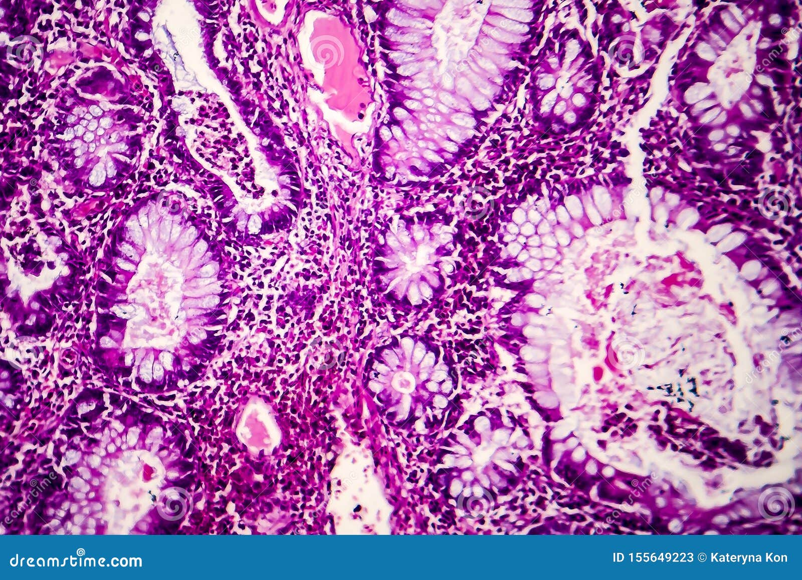 Villous Colon Adenocarcinoma, Light Micrograph Stock Image - Image of ...