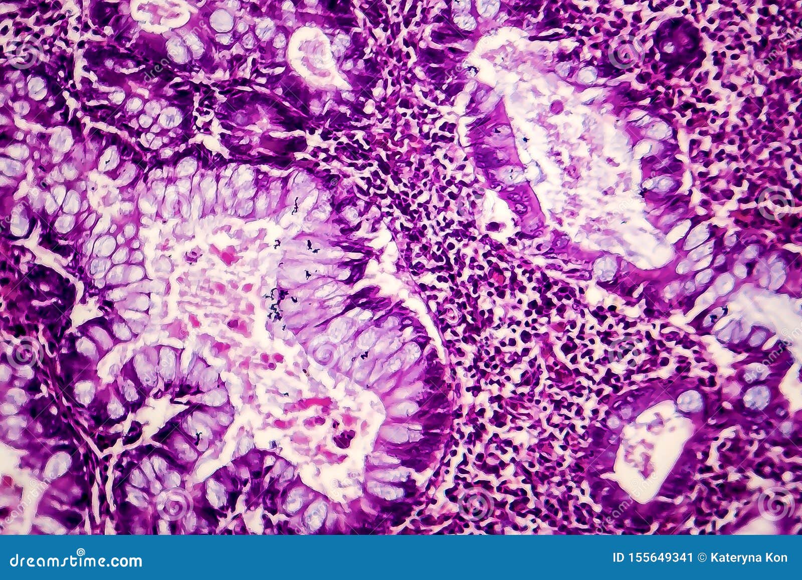 Villous Colon Adenocarcinoma, Light Micrograph Stock Image - Image of ...
