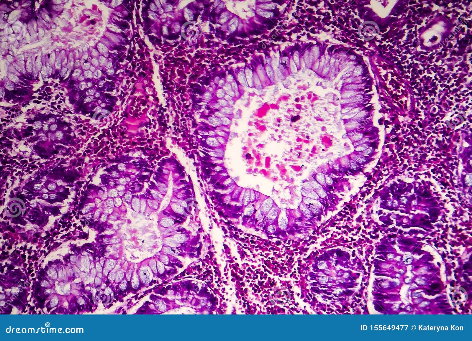 Villous Colon Adenocarcinoma, Light Micrograph Stock Image - Image of ...