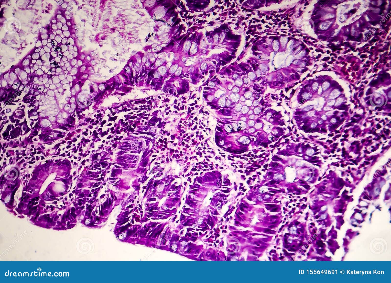 Villous Colon Adenocarcinoma, Light Micrograph Stock Image - Image of ...