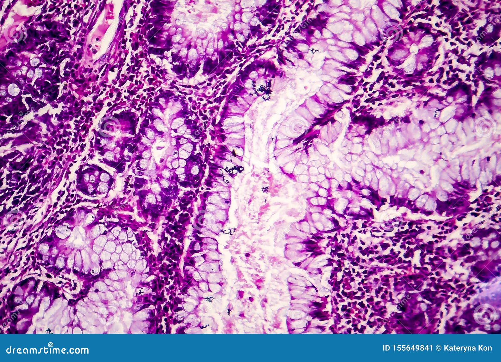 Villous Colon Adenocarcinoma, Light Micrograph Stock Image - Image of ...