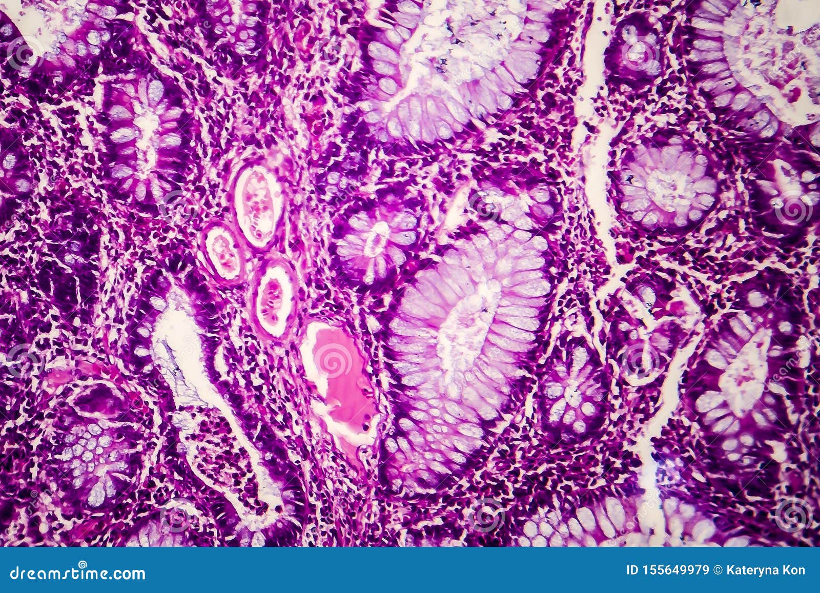Villous Colon Adenocarcinoma, Light Micrograph Stock Image - Image of ...