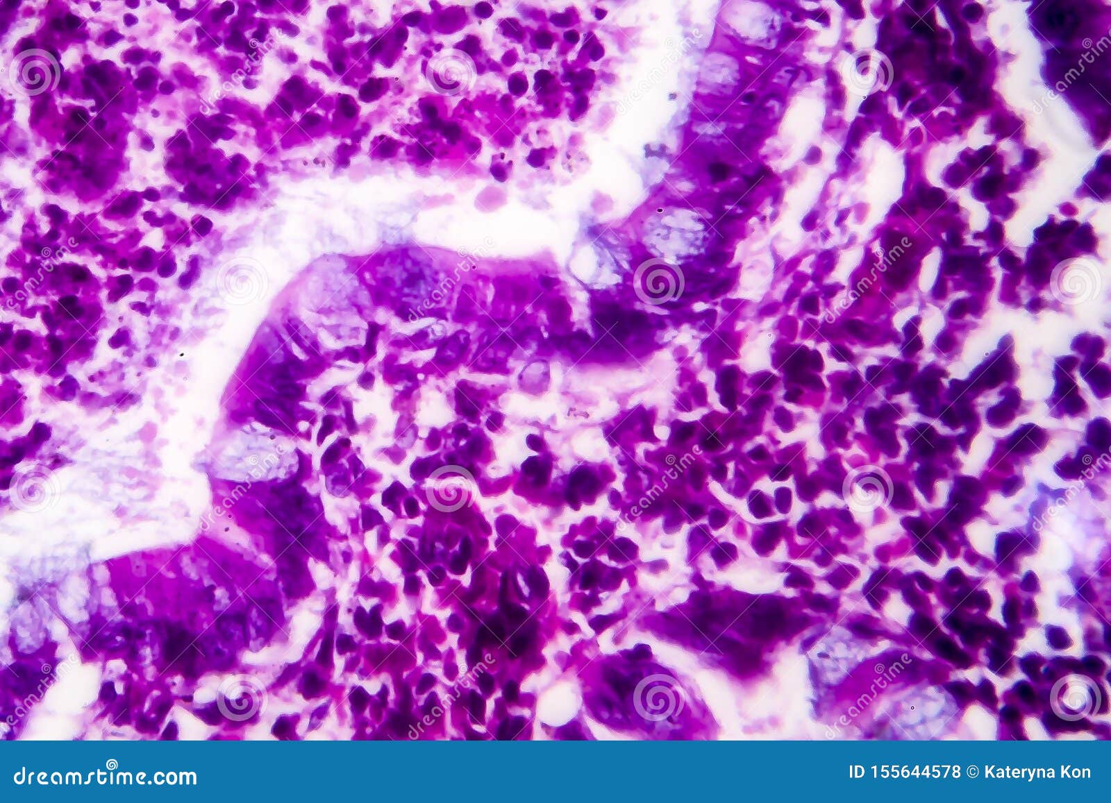 Villous Colon Adenocarcinoma, Light Micrograph Stock Photo - Image of ...