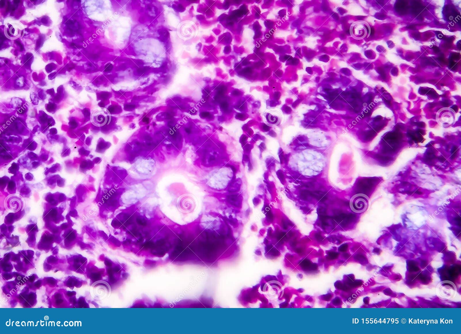 Villous Colon Adenocarcinoma, Light Micrograph Stock Image - Image of ...