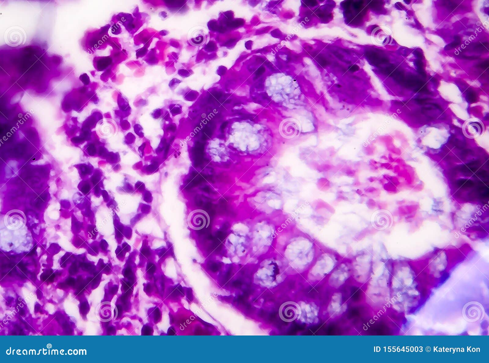 Villous Colon Adenocarcinoma, Light Micrograph Stock Image - Image of ...
