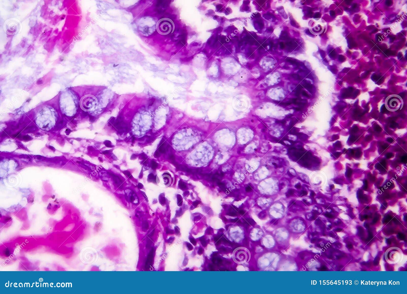 Villous Colon Adenocarcinoma, Light Micrograph Stock Image - Image of ...