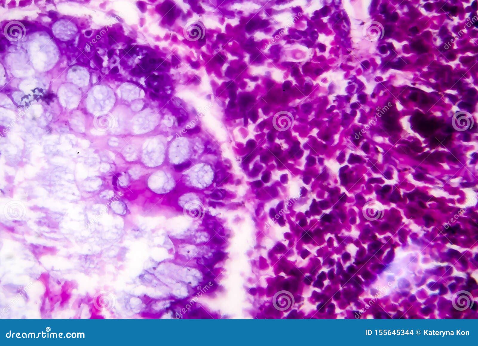 Villous Colon Adenocarcinoma, Light Micrograph Stock Photo - Image of ...
