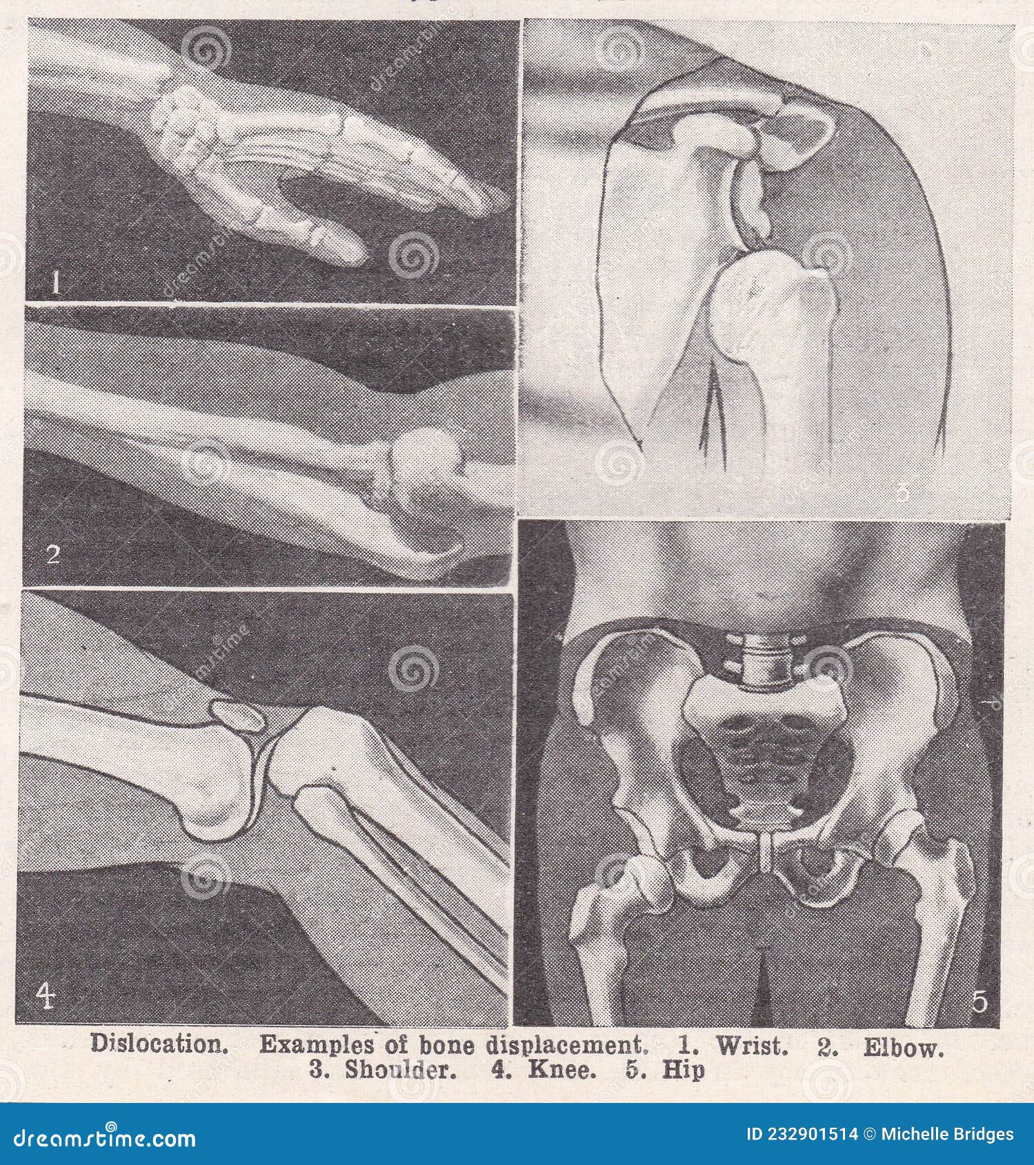 Knee Dislocation Black Vector Concept Icon. Knee Dislocation Flat ...