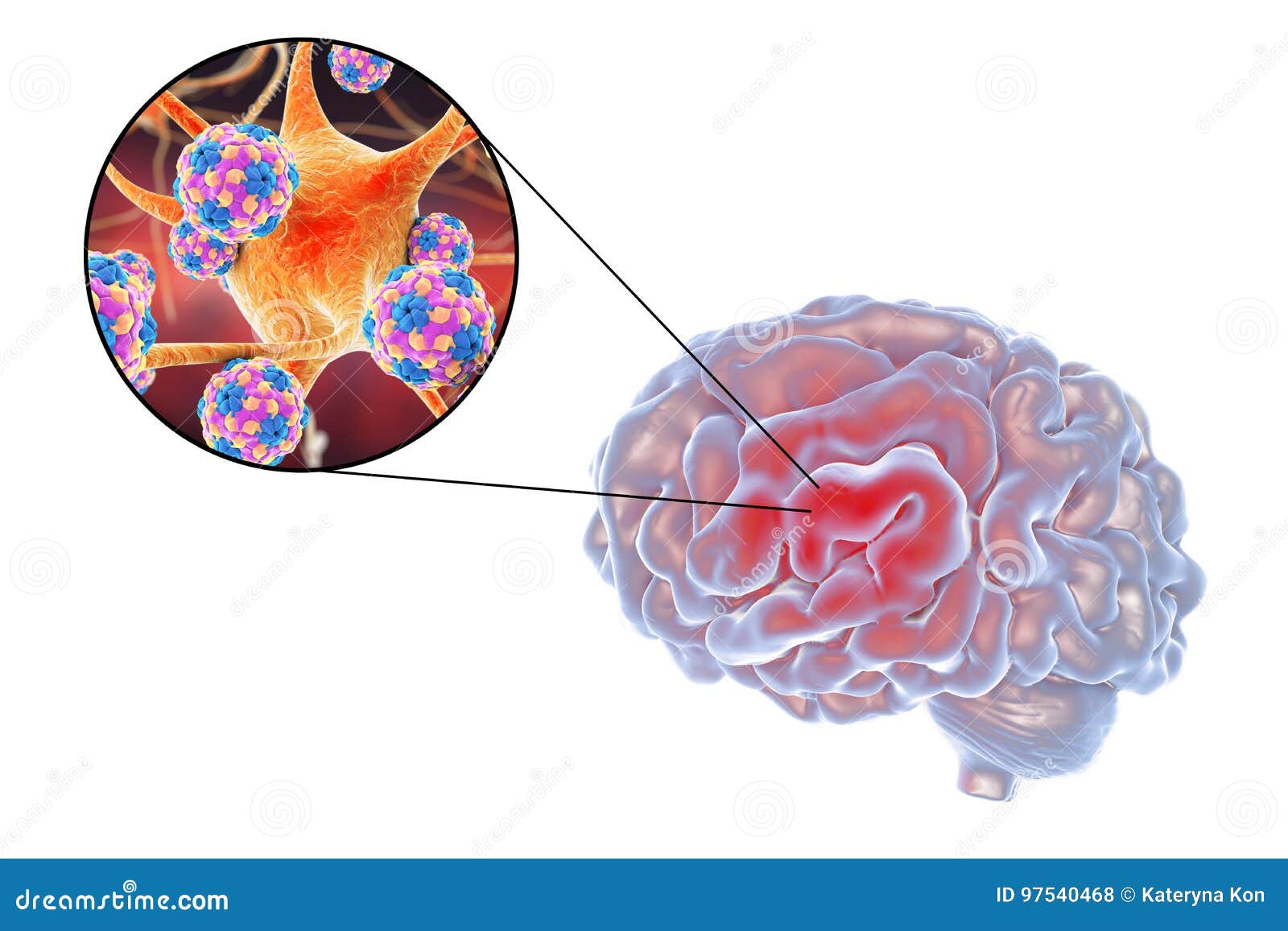 Viral Encephalitis, Brain And Neurons Infected By Viruses Royalty-Free ...