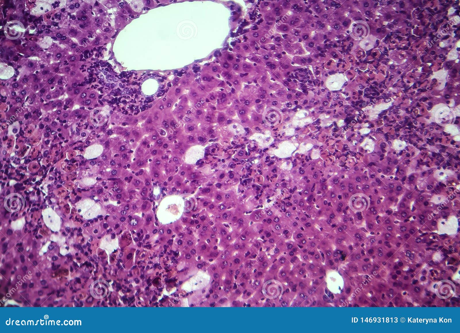 Viral Hepatitis, Light Micrograph Stock Illustration - Illustration of ...