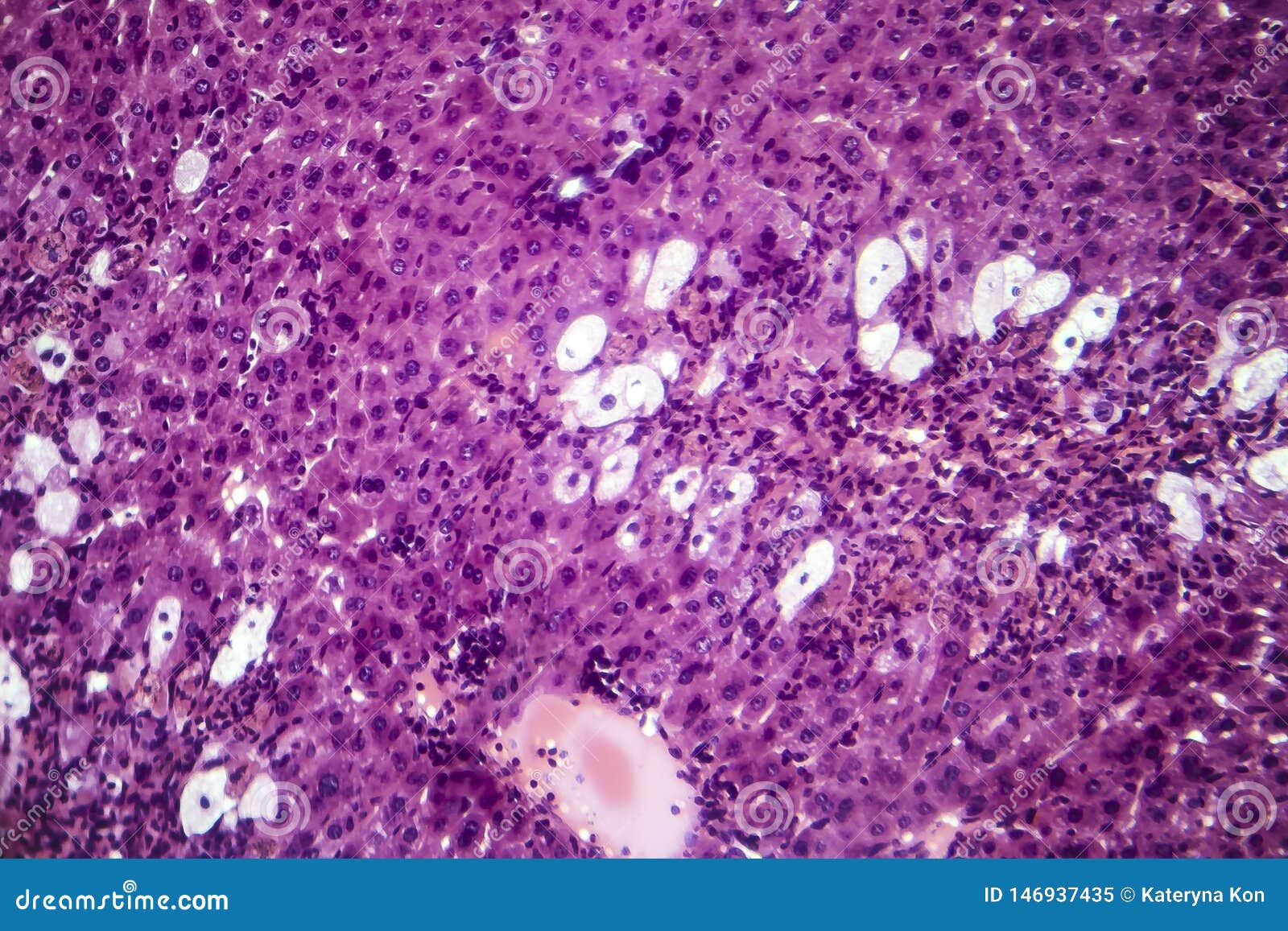 Viral Hepatitis, Light Micrograph Stock Illustration - Illustration of ...