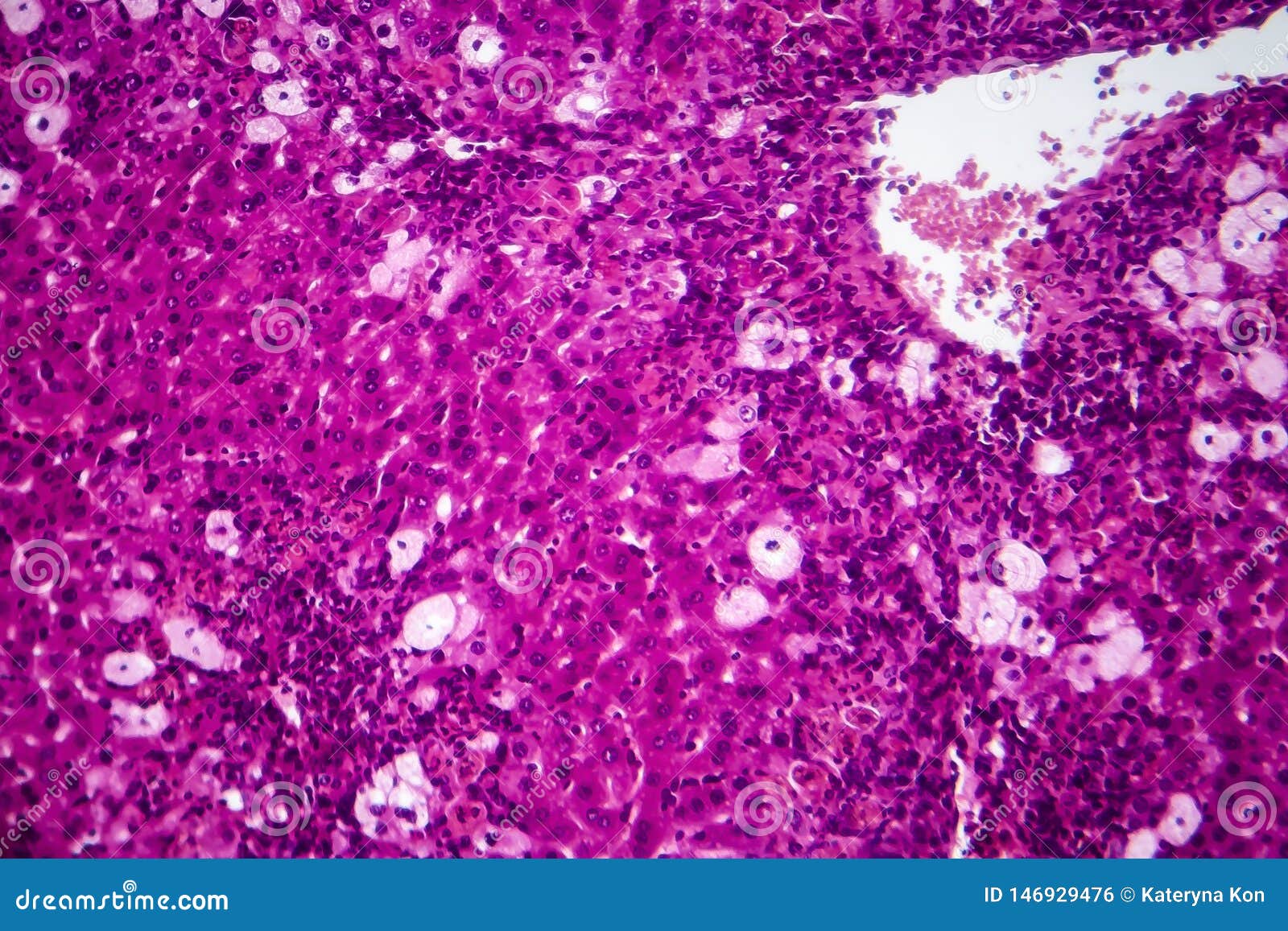 Viral Hepatitis, Light Micrograph Stock Illustration - Illustration of ...