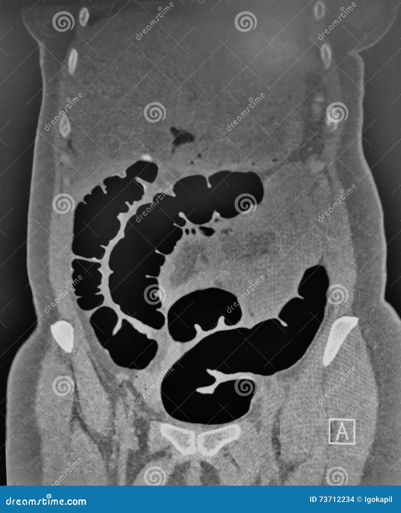 Virtueel Colonoscopy Ct Aftastenbeeld Stock Foto - Image of aflopend ...
