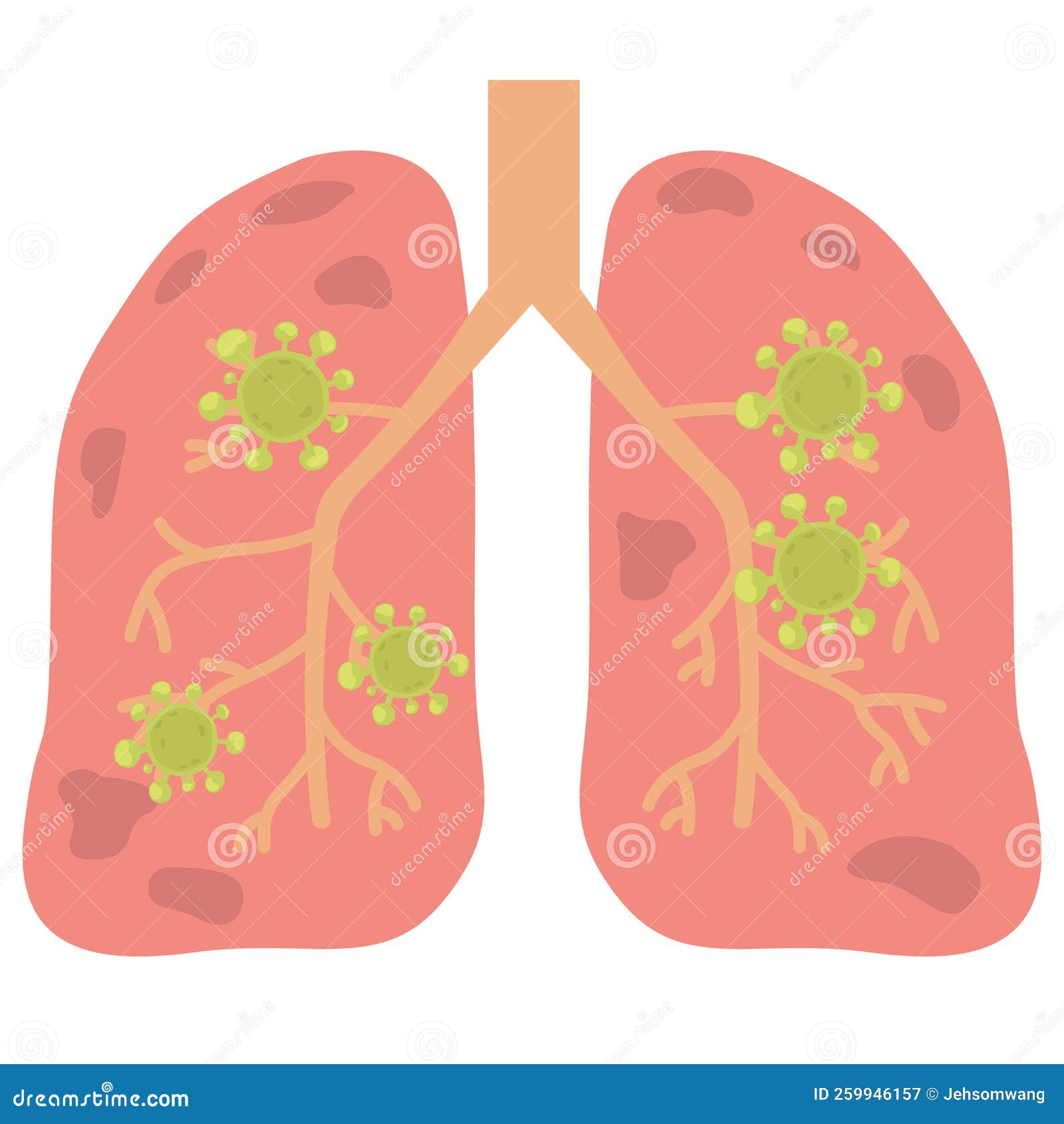 Virus or Bacterial Infects Lungs.virus Invades Lungs Stock Vector ...