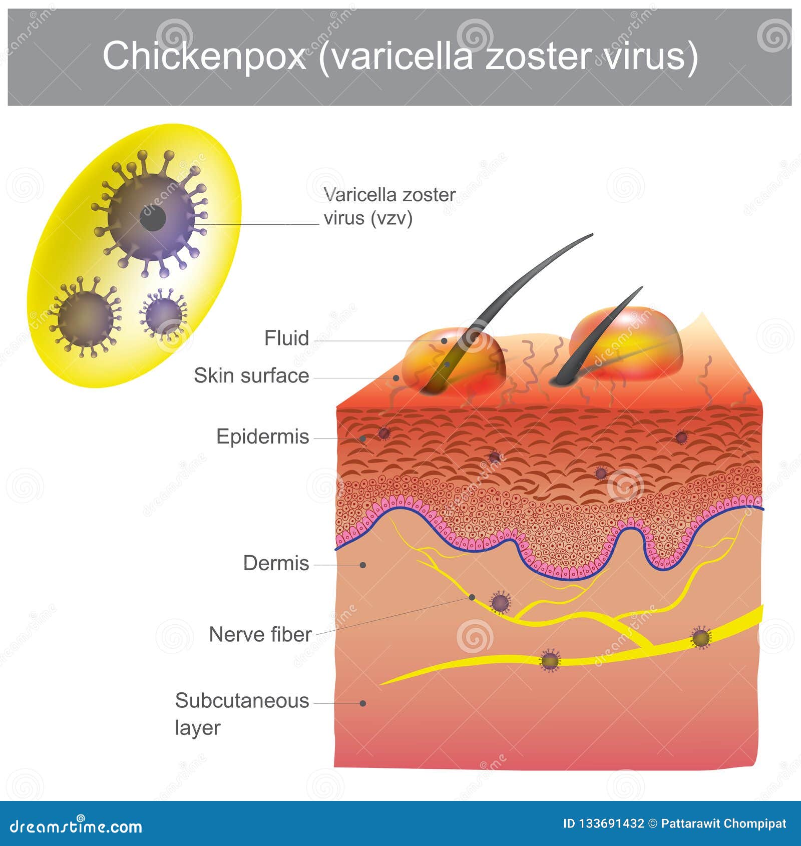 Virus De Zoster De Varicella De Varicelle Illustration de Vecteur ...