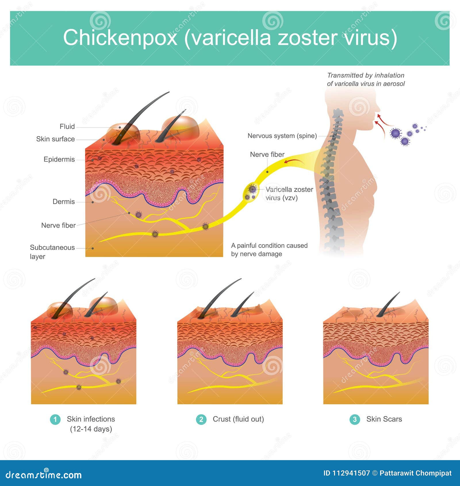Varicela Ilustraciones Stock, Vectores, Y Clipart – (427 Ilustraciones ...