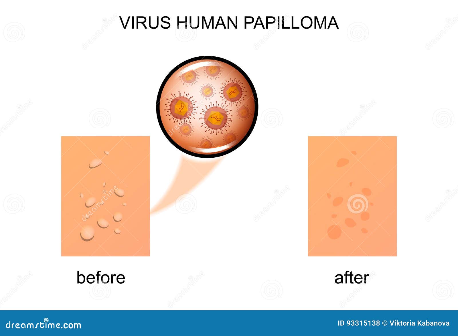Virus human papilloma stock vector. Illustration of magnification ...