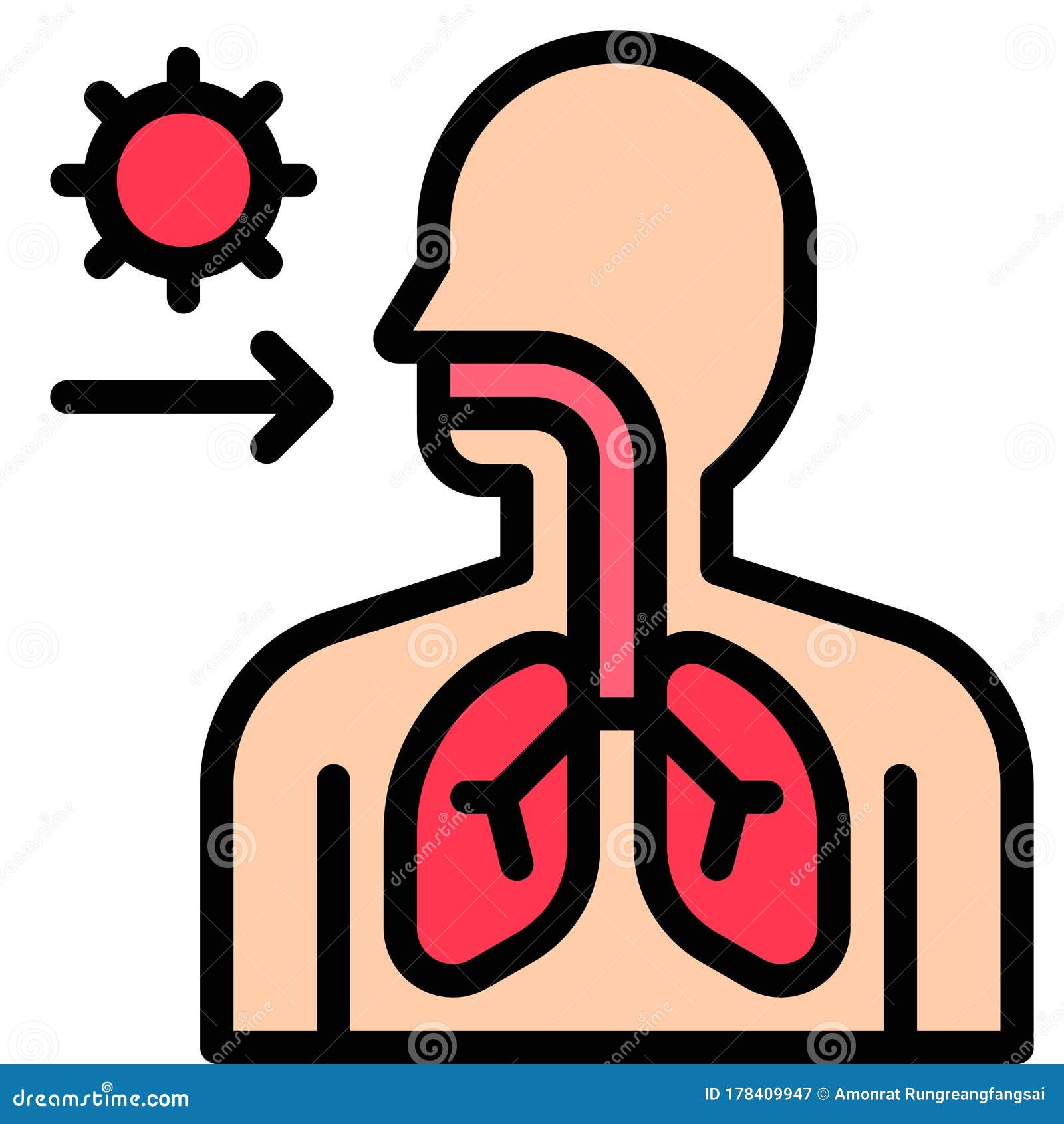 Pneumonia Vector Illustration. Labeled Diagram With Causes And Symptoms ...