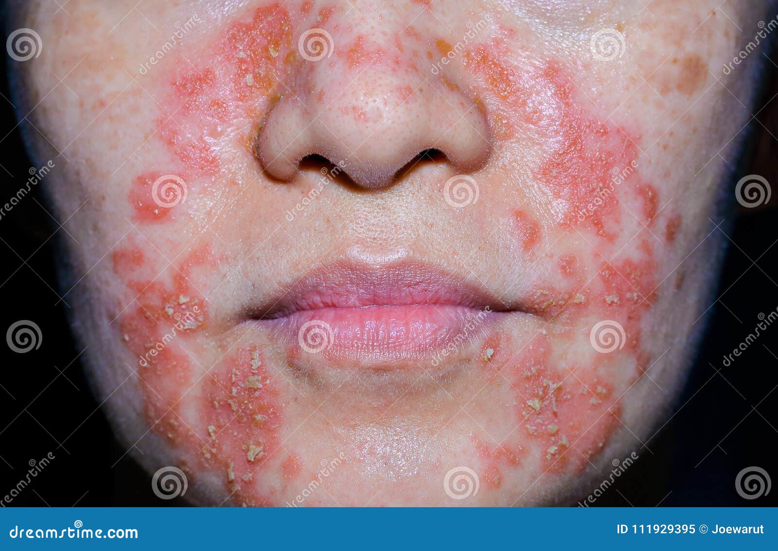 Visage De Dermatite Seborrheic Image stock - Image du patient, malade ...