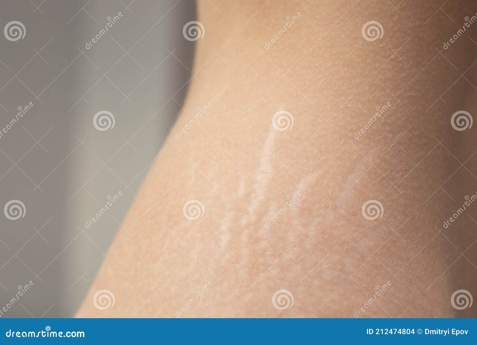 Visible Stretch Marks on Woman Hips Stock Photo - Image of cellulite ...
