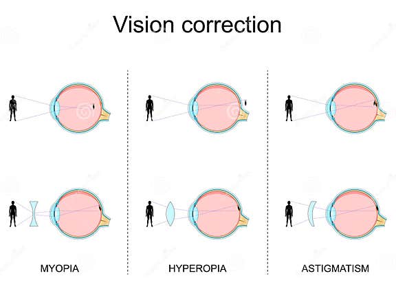 Vision Defects. Myopia, Hyperopia, Astigmatism Stock Vector ...