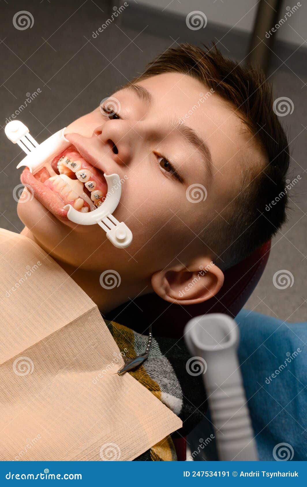 Visit To the Orthodontist, Installation of Braces on the Upper Teeth ...