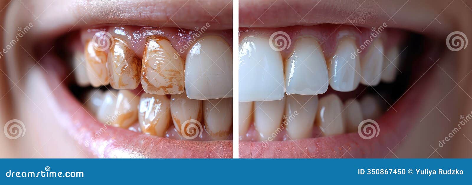 Visual Display Of Teeth Transformation: Professional Whitening Results ...