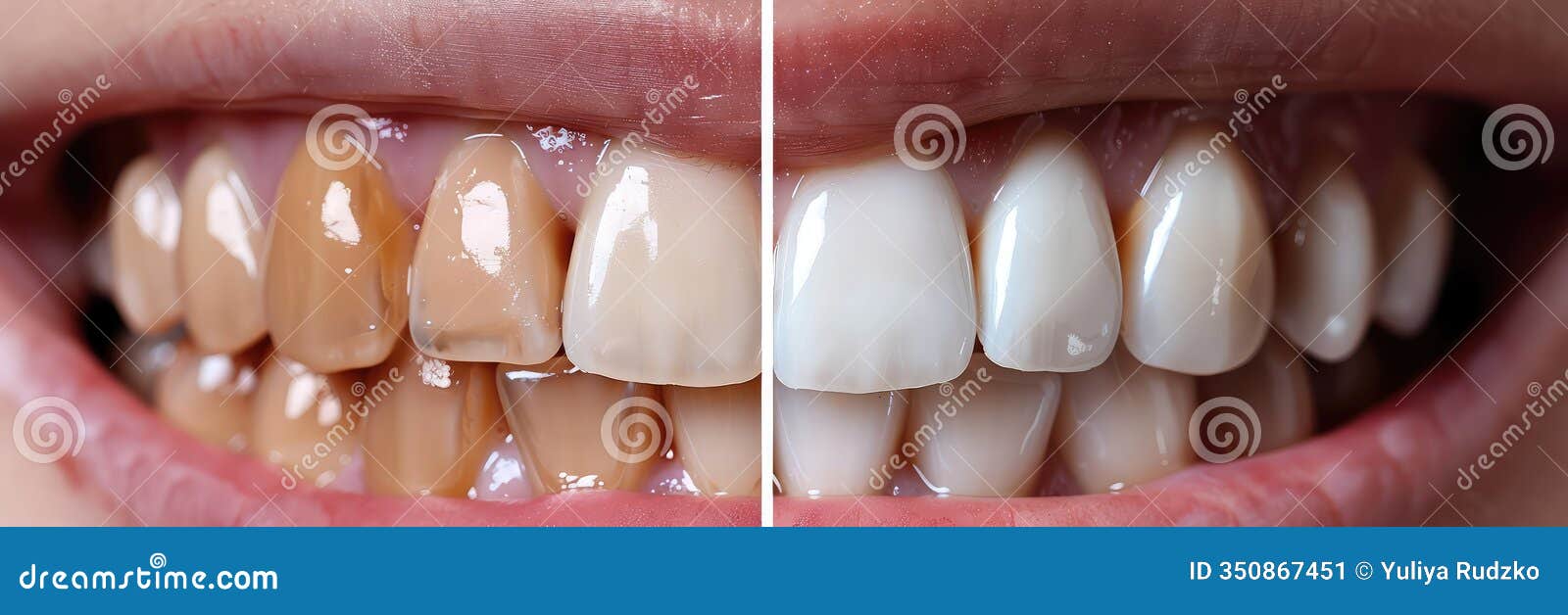 Visual Display of Teeth Transformation: Professional Whitening Results ...
