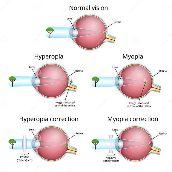 Vision Problems and Their Correction, Myopia and Hyperopia Stock ...
