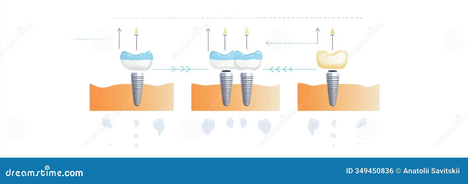 Visual Representation of the Dental Implant Process Showcasing Each ...