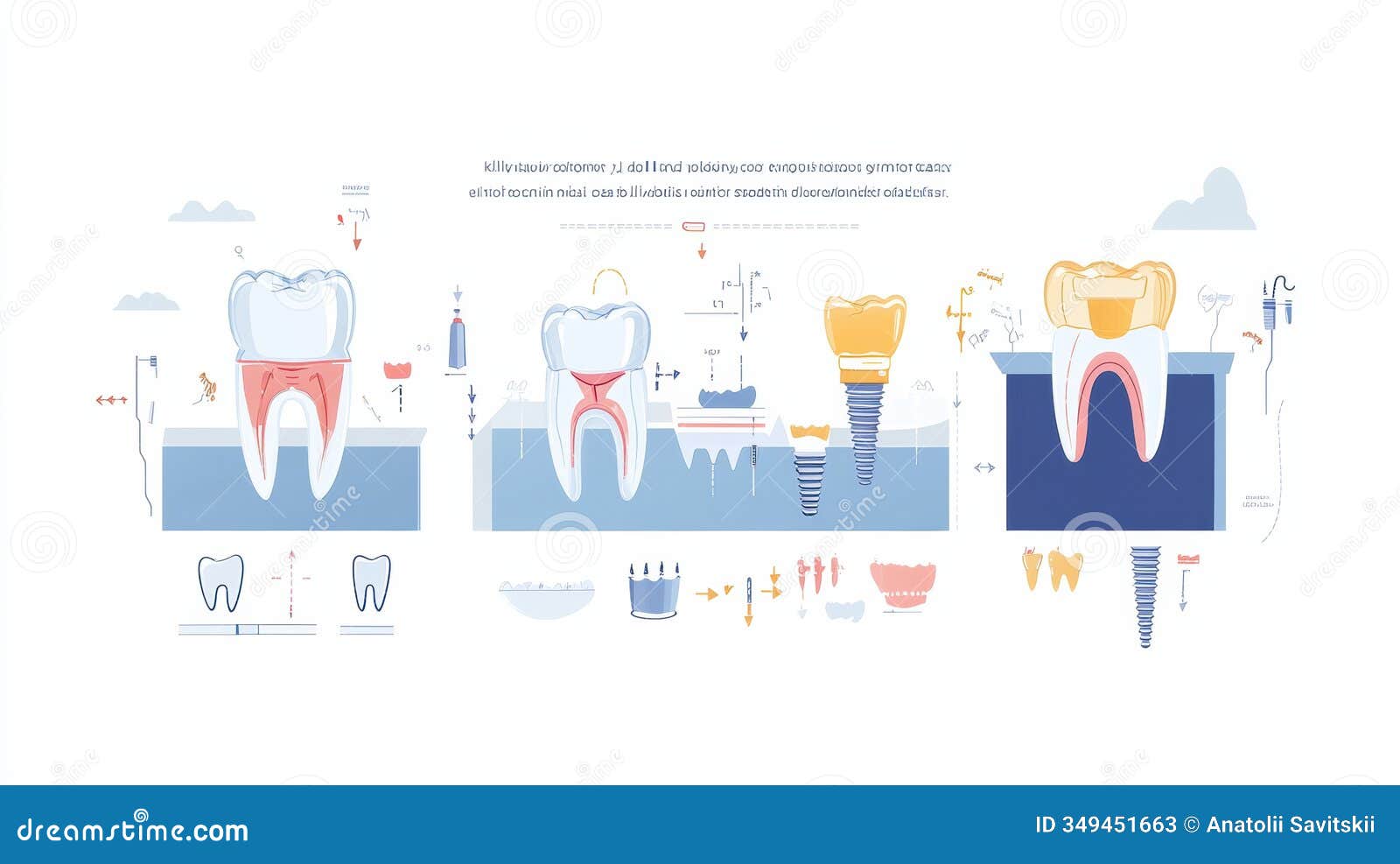 Visual Representation of the Dental Implant Process in Three Stages ...