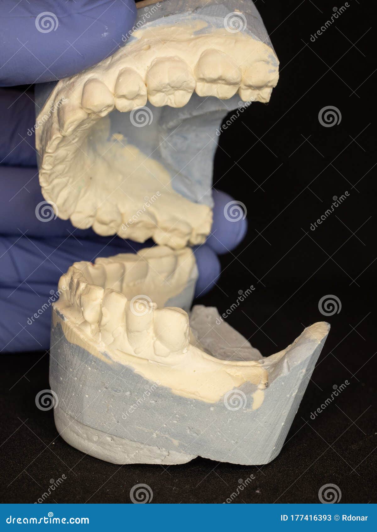 Orthodontic Cast Of Human Jaw For Prosthetics And Braces.Ceramic Crown ...