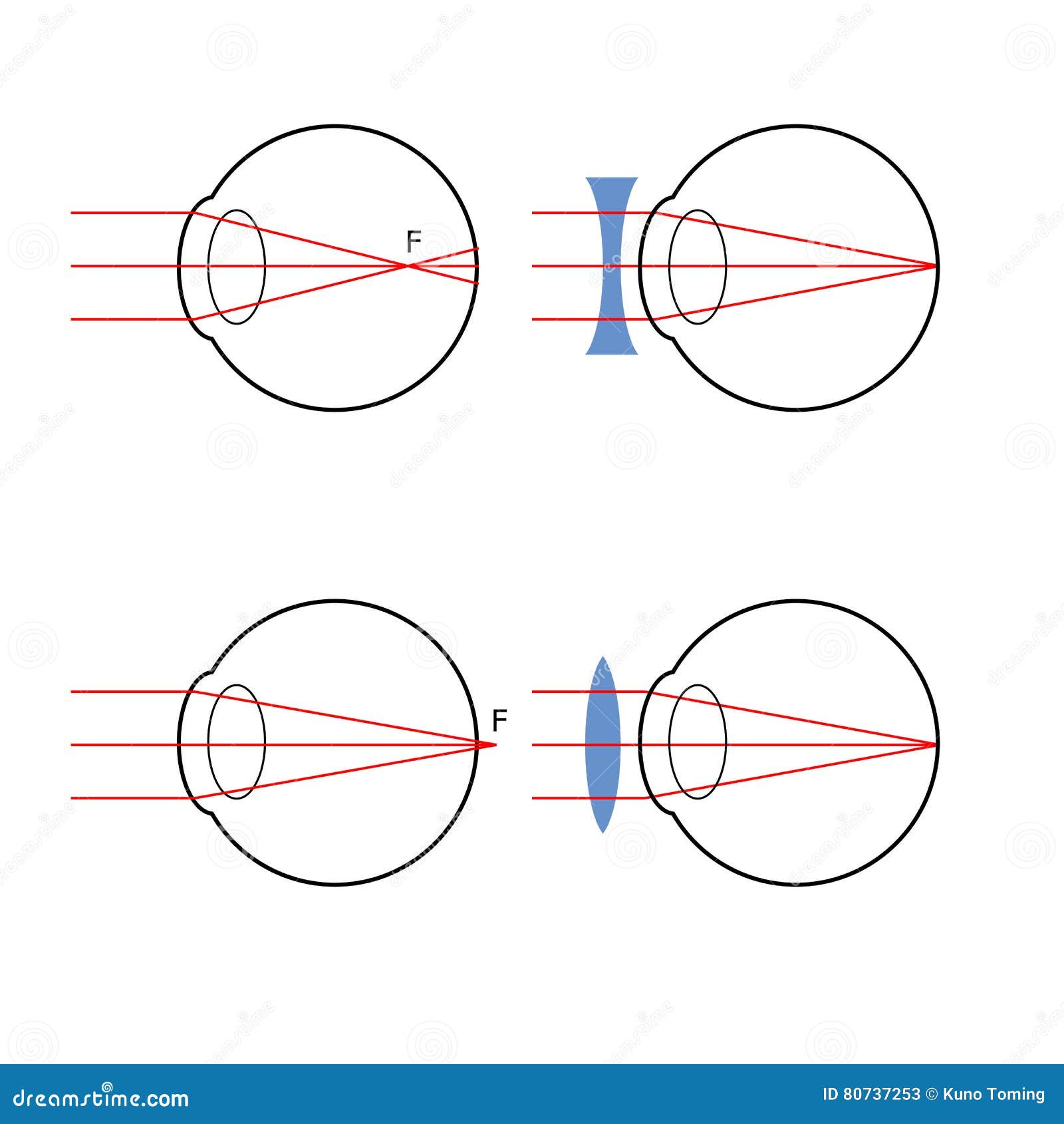 Eye Optical Defects : Myopia And Hyperopia. Vector | CartoonDealer.com ...