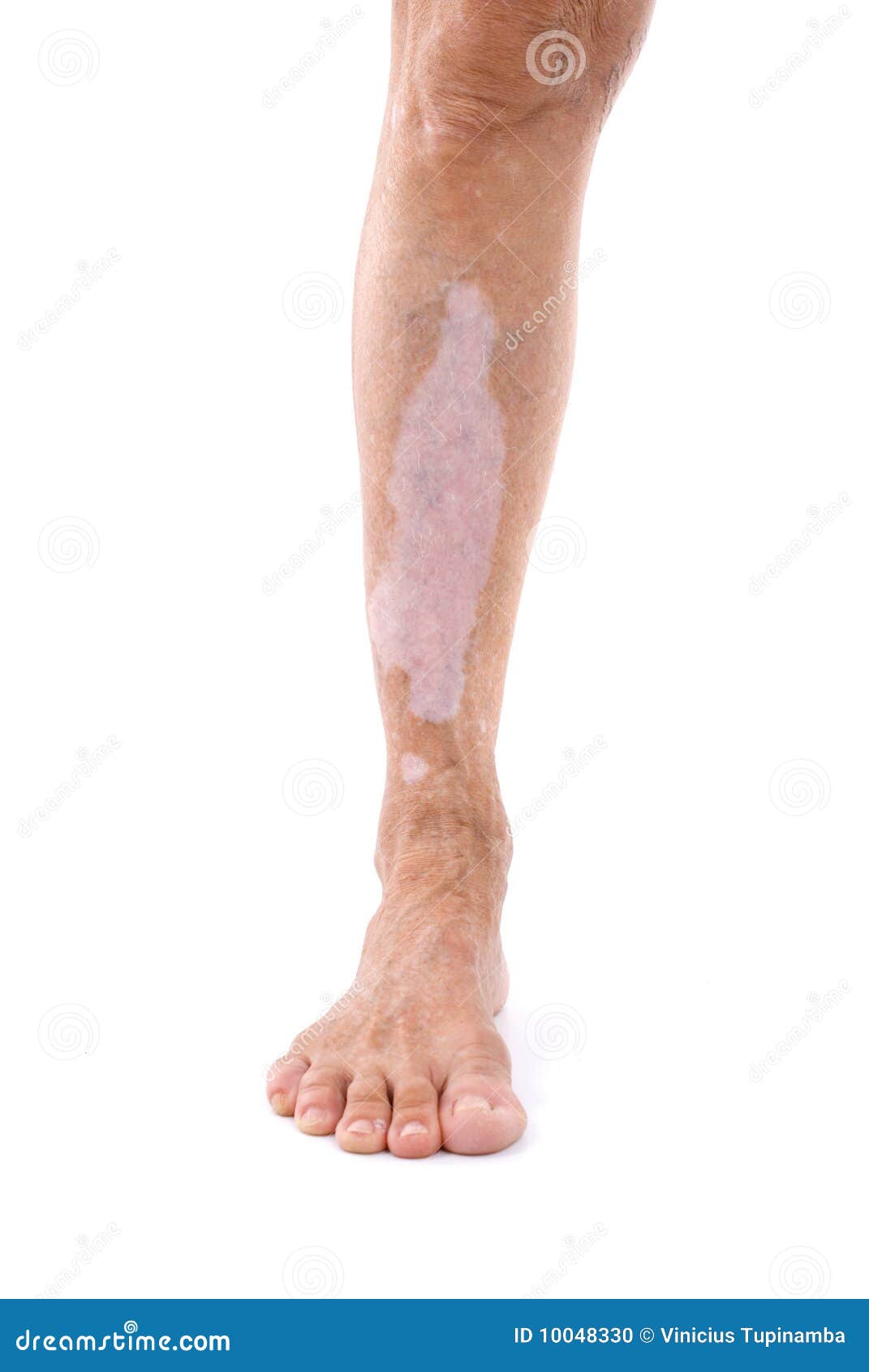 Vitiligo stock photo. Image of white, medical, skin, sick - 10048330