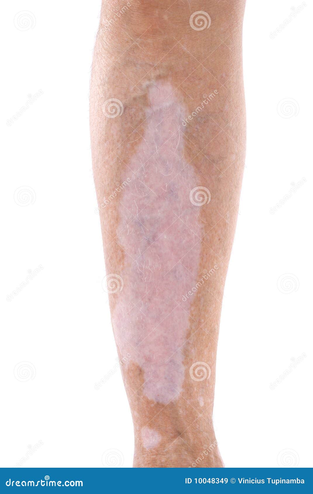 Vitiligo stock image. Image of isolated, problem, medical - 10048349