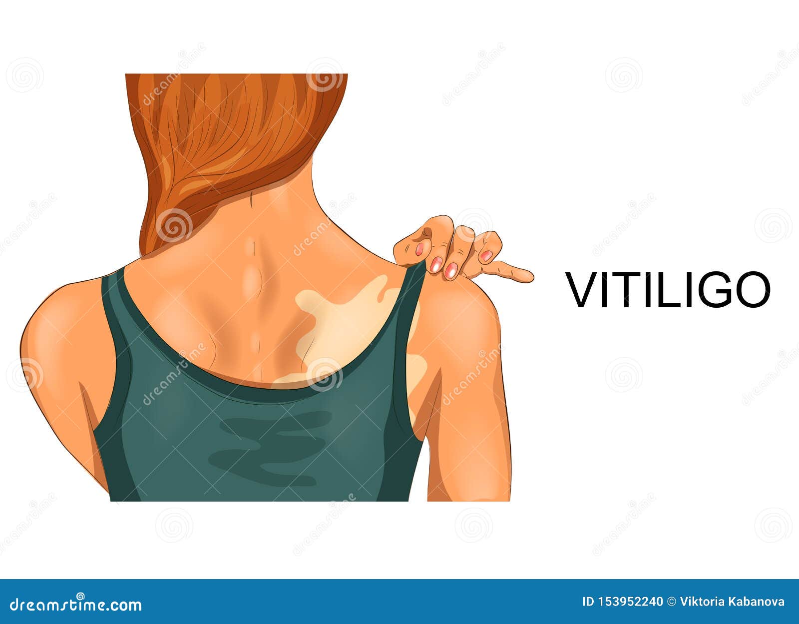 Vitiligo Cartoon Vector | CartoonDealer.com #60537245