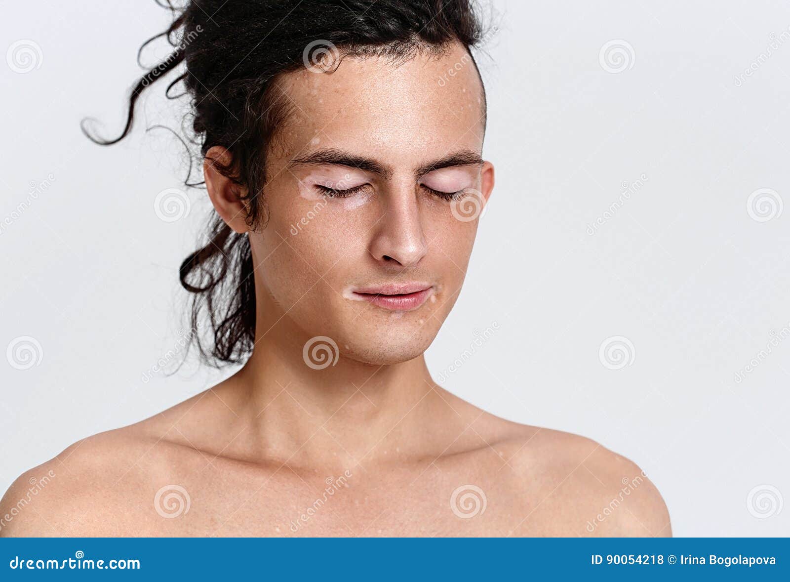 Vitiligo man portrait stock photo. Image of disorder - 90054218
