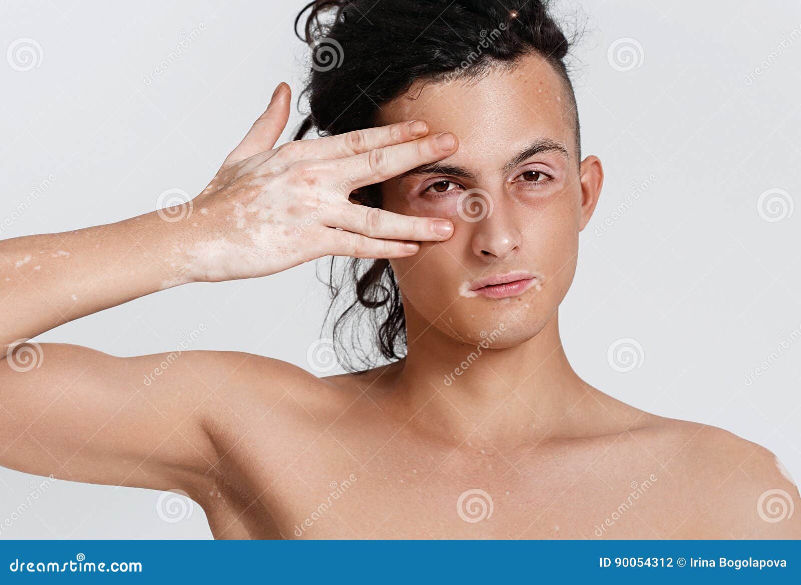 Vitiligo man portrait stock photo. Image of body, looking - 90054312